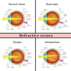 Refractive Error | Summit Eye Surgeons